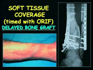 Salvaging Severe Pilon Fractures