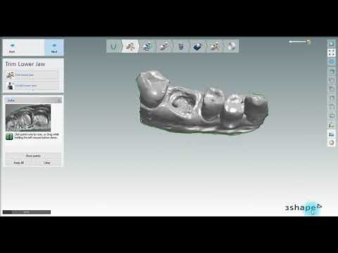 How to Design a Post & Core Standard Digital Model in 3Shape