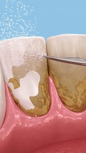 clip-3894815727-oral-hygiene-scaling-root-planing-3d-animation