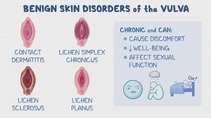 Video: Vulvar skin disorders (benign): Clinical sciences - Video Explanation! | Osmosis | Osmosis