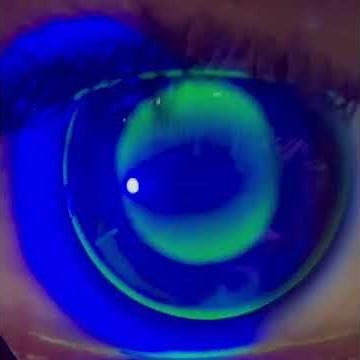 Toric 2.50D Ortho k Lens performance on toric corneal surface