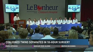 Conjoined twins separated in 18-hour surgery