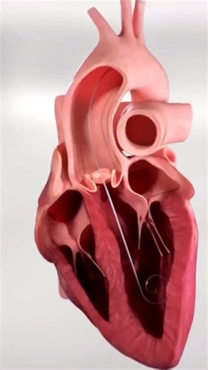 World of Biology | Aortic Stenosis is a type of heart disease where the Aortic valve becomes narrowed and no longer opens properly. The Meridian valve is... | Instagram