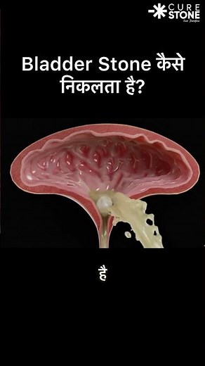 How bladder stones are removed