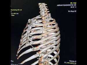 Trauma chest with fractured ribs and pulmonary contusions.