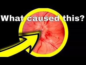 What is Papilledema?