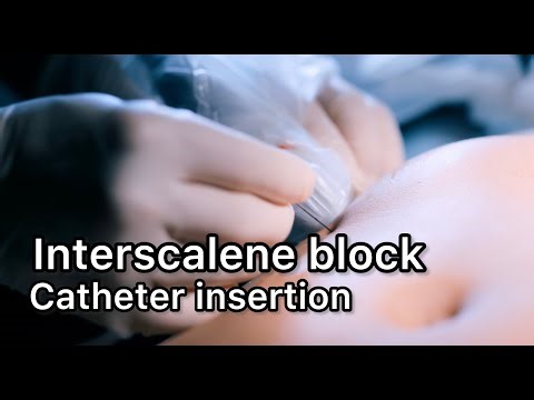 Interscalene brachial plexus block/ catheter insertion [Education] /持続斜角筋間ブロック／神経ブロック