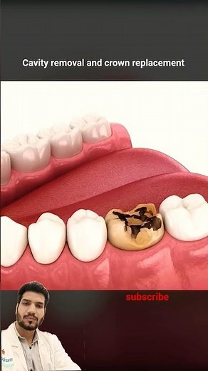 Cavity removal and crown replacement in 3d Animation 👨‍⚕️⚕️
