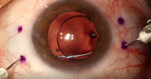 Visconeedling for IOL Capture - Eyetube