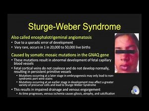 Sturge-Weber Syndrome