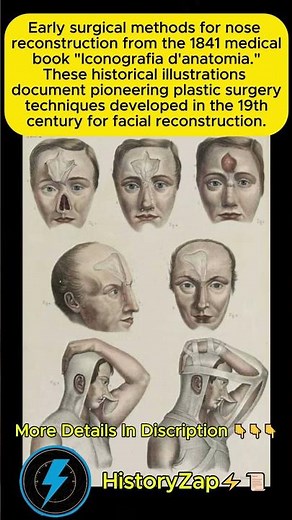 🩺 How Doctors Rebuilt Noses in 1841: Historical Surgery Methods!