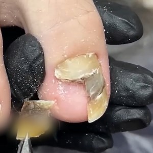 Nail fungus treatment! | Alena Lavrenteva