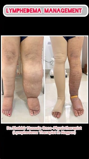 Lymphedema Recovery~Physiotherapy Exercises & Treatment for Swelling Relief #shortsfeed #lymphedema