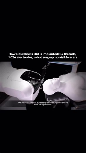 Artificial Intelligence | Technology | Prompts on Instagram: "Neuralink shows how their BCI is implanted into the brain using ultra-thin threads and a surgical robot. The device lets people with paralysis control computers, move cursors, and even communicate using only their thoughts. The future of mind-tech integration is here. 🎥: @XFreeze"