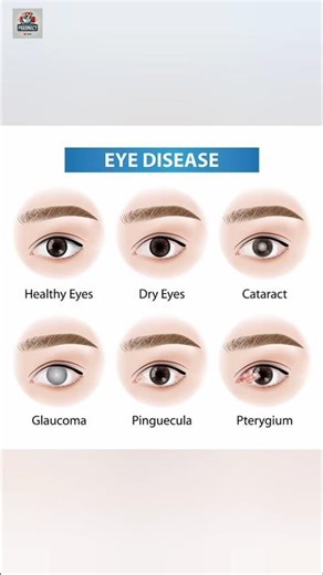 different eye 👁️ disease #eyes #eyediseases
