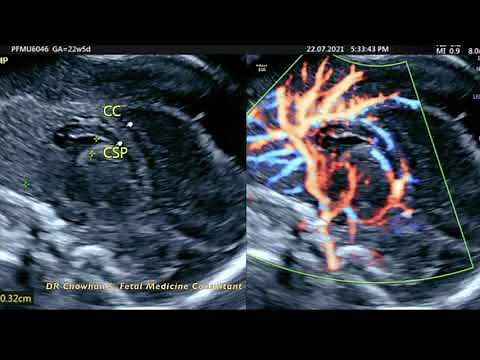 PARTIAL Agenesis of Corpus Callosum