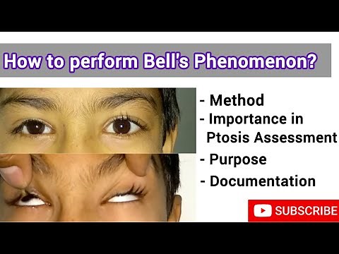 Bell's Phenomenon in Optometry | Understanding Eye Movement and Reflexes