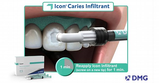 Icon Smooth Surface Caries Infiltrant, Quick Guide - DMG America