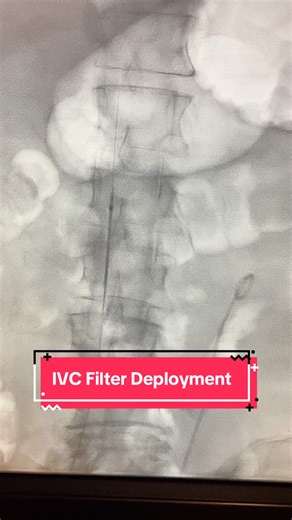 IVC (inferior vena cava) filter deployment. #interventionalradiology #xray #specials #radiology