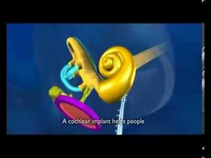 Cochlear implants - how do they work?