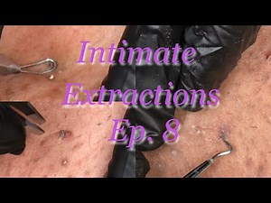 Intimate Extractions Ep. 8 | BK Beauty Spa