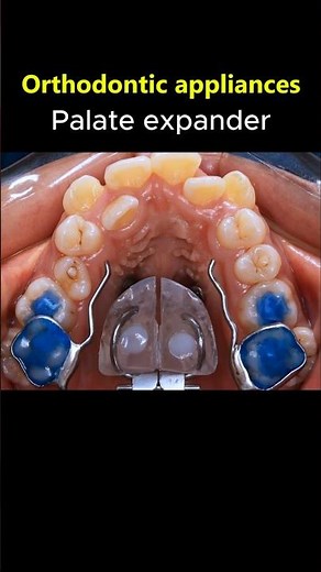 Palate expander. Braces appliances for overbite teeth #braces #dentist #orthodontist