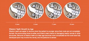 Wisdom Teeth Extraction - Blue Wave Dental Implants and Oral Surgery