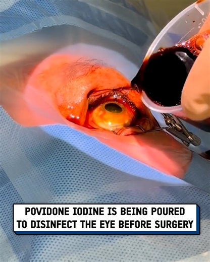 I wasn't prepared to have my eye disinfected 👀😱 #eyecare #eyes #medical | UNILAD Tech