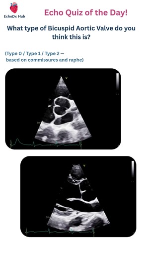 Bicuspid Aortic Valve
