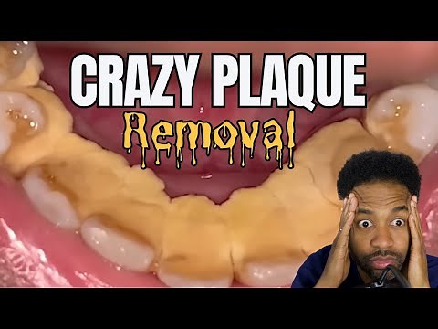 What Happens If You Never Brush Your Teeth?