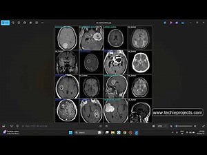 Diagnosing Strokes with Imaging CT, MRI Images | Brain Stroke Detection using Machine Learning