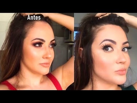 Frontoplastia (cirurgia da testa): Quanto custou tudo? Exames?