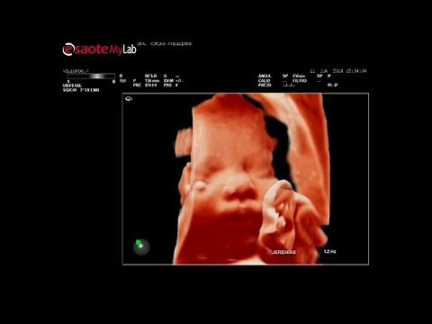 Scan fetal de 20 semanas - Dr. Alberto Sosa Olavarría