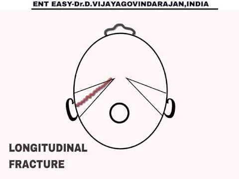 ENT EASY: Temporal Bone fractures made easy to understand:Longitudinal and Transverse