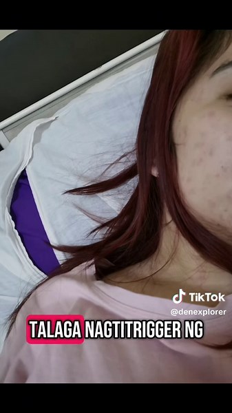 Paano Magpa-Allergy Skin Test sa PGH?