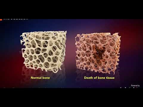 Avascular Necrosis - Core Decompression