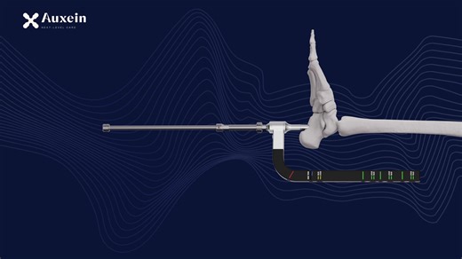 When ankle stability is non-negotiable, alignment and fixation matter. The Ankle Arthrodesis Nailing System is designed to deliver stable intramedullary fixation and controlled alignment for ankle fusion supporting reliable outcomes in complex cases. Built to address severe deformities, advanced arthritis, non-unions, and failed ankle reconstructions, it helps surgeons restore stability where it’s needed most. Engineered for fusion. Designed for durability. | Auxein