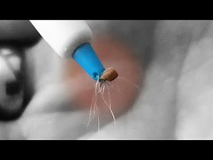 How to remove a tick using a tick removal tool