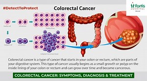 Colorectal cancer usually begins with a small lump or polyp in the rectal region of the body. Watch Dr. Jitender Rohila, Consultant, GI Surgical Oncology, Fortis, Mohali, explain its warning signs, diagnosis techniques, and treatment methods. For appointments, call 7272872728. #DetectToProtect #AtFortisWeCare #CareForGood | Fortis Hospital Mohali