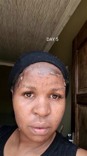 day 5 #SAMA28 #algaepeel #algaepeelsouthafrica #goviral #fyppppppppppppppppppppppp #foryou #fyp #beauty