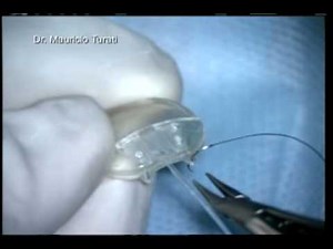 Ahmed Valve, preparation for surgery - Dr. Mauricio Turati Acosta
