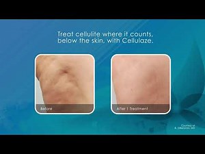 Cellulaze - Laser Cellulite Treatment