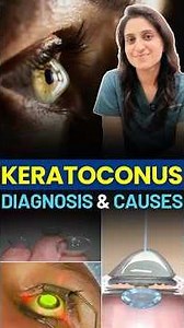 What is Keratoconus? | Causes, Symptoms & Treatment Options