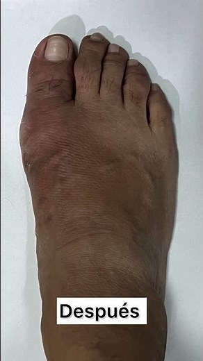 Juanetes a los 2 meses operados con técnica MICA #doctorjuancarlosalbornoz