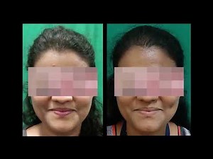 Dimple creation surgery - Operative video