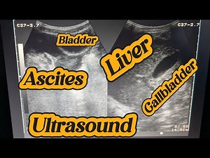 How to Ultrasound Ascites | Free Fluid in Abdomen and Pelvis | Abdomino Pelvic Ascites