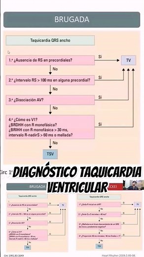 Brugada Criteria: Diagnosis of wide QRS tachycardia (Ventricular)