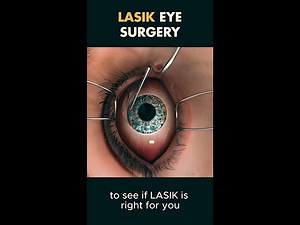 LASIK Eye Surgery Procedure | 3D Medical Animation Explanation Video| Follow for More #lasik