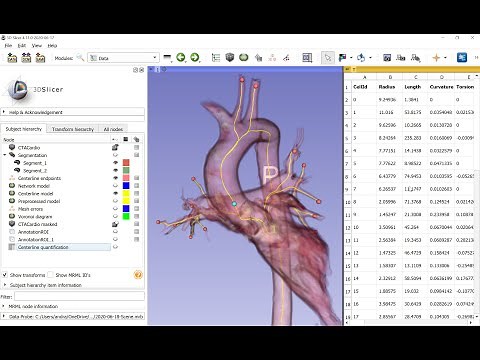 New vessel branch extraction module for 3D Slicer