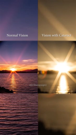 Normal vs Cataract Vision #drbhanupangtey #eyes #cataract